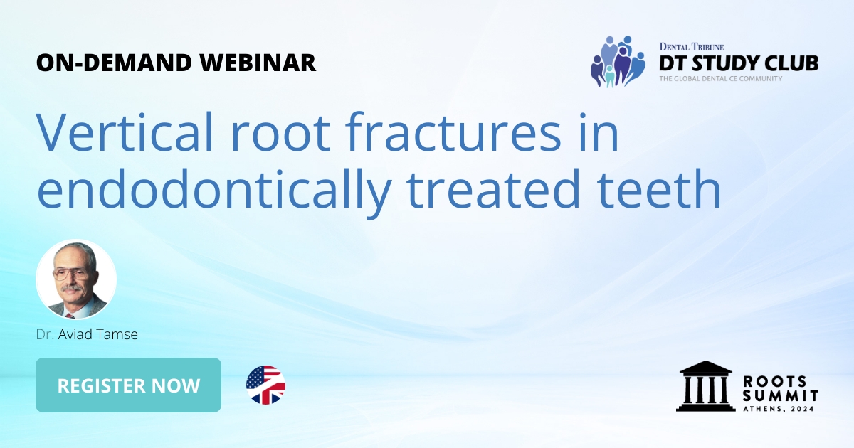 Vertical root fractures in endodontically treated teeth - Webinar ...