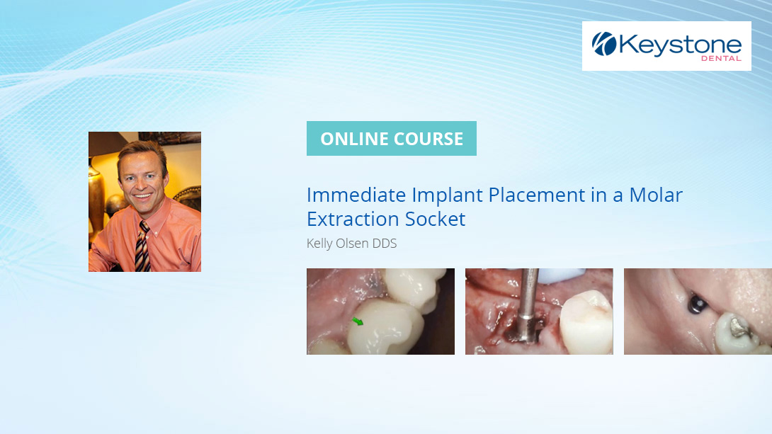 DT Study Club Webinar: Immediate Implant Placement in a Molar ...