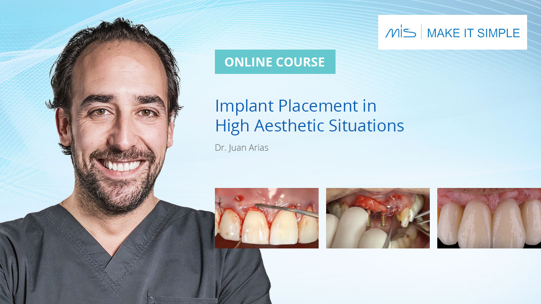 DT Study Club Webinar: Implant Placement in High Aesthetic Situations